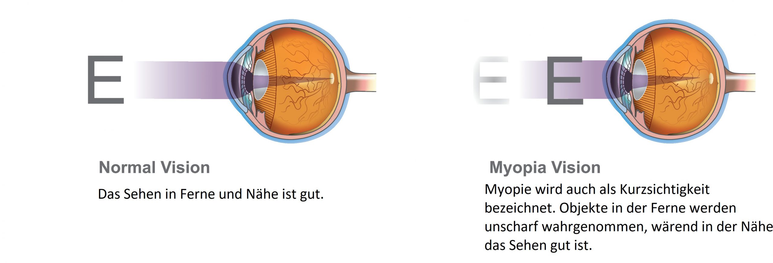 „Schulmyopie“ – was ist das denn? - Berufsverband Orthoptik Deutschland e.V.